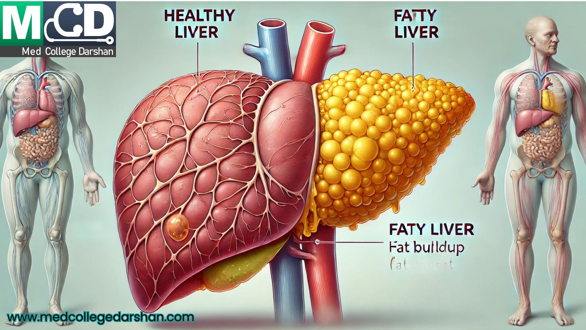 Why is Fatty Liver Becoming More Common Among the Young Generation ...